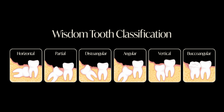 Wisdom tooth extraction Melbourne | Dr Jaclyn Wong