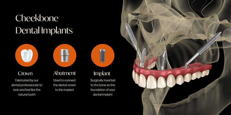 All-on-4 dental implants Melbourne | Dr Jaclyn Wong